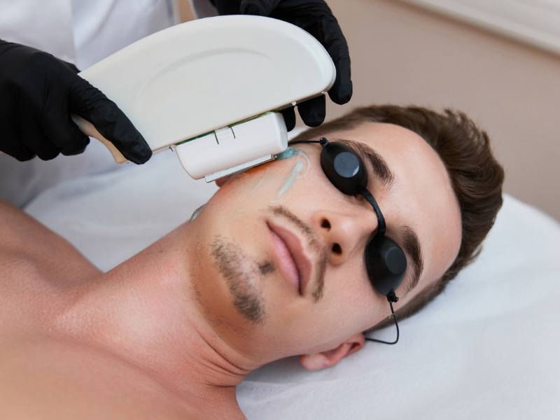 Quais são os Benefícios da Depilação a Laser na Barba? Veja!